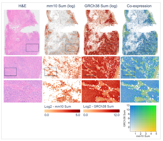 Can Visium HD Spatial Gene Expression interrogate patient-derived ...